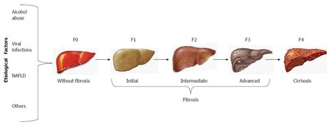 Genetic Metabolic And Environmental Factors Involved In The