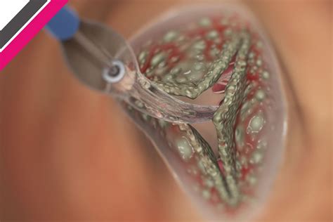 Valvuloplasty Aruna Cardiac Care
