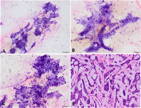 Palato De Carcinoma Adenoide Cistico Ident Ia Tumor De Glândula