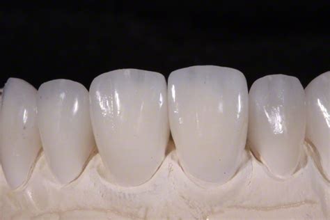 Feldspathic Veneers Archives Williams Dental Lab