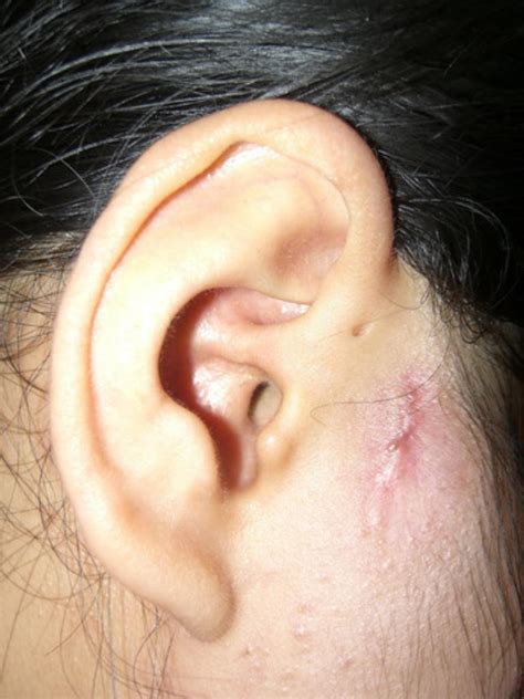 Preauricular Pit Infection