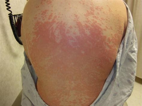 Streptococcal Skin And Skin Structure Infections Intechopen