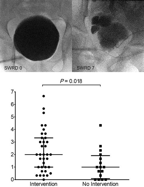 Cystometrogram Appearance In Puv Is Reliably Quantified By The Shape Wall Reflux And