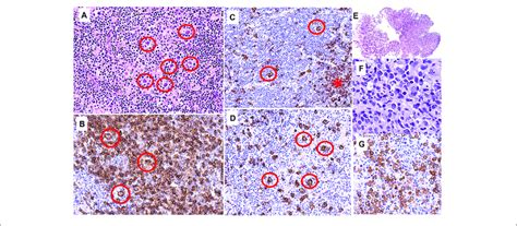 Axillary Lymph Node Biopsy April 2017 A D And Gastric Biopsy