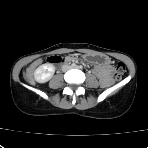 Appendicitis Ct Radiopaedia Treatment May Include Intravenous Antibiotics Or Surgical Removal