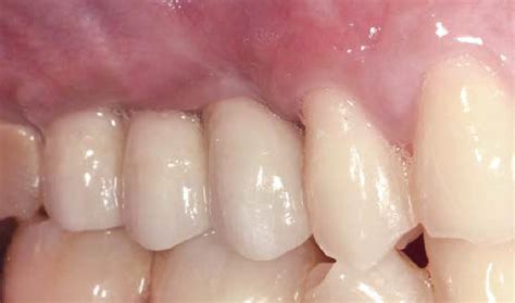 Horizontalvertical Defect In The Anterior Maxilla 3 Teeth Gap Geistlich