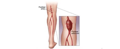 Vascular And Endovascular Surgery In Adajan Surat