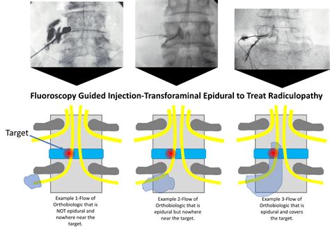 Fluoroscopy Vs Ultrasound For Orthobiologic Spine Procedures Regenexx