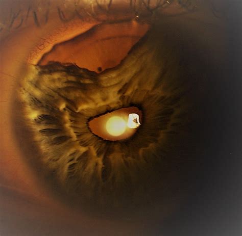 Ophthalmology Iris Ophthalmicimaging Ophthalmicphotography Ops