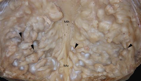 Severe Form Type D Of Hyperostosis Frontalis Interna The Midline Of