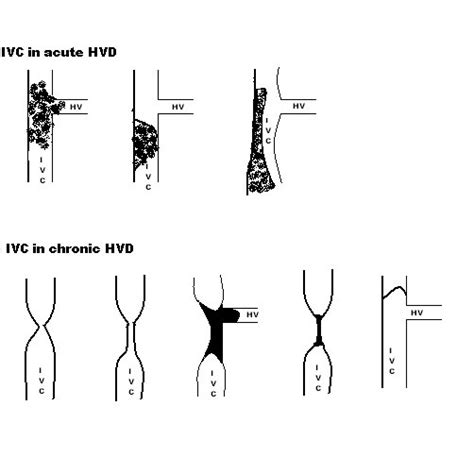 Presence Of Dilated Superficial Veins In Abdomen And Ascites In HVD Download Scientific Diagram