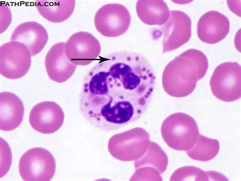 Neutrophil With Toxic Granulation In Severe Infections