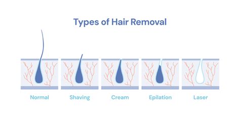 7 Tips For A Comforable Laser Hair Removal Emla