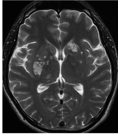 Figure 1 From Imaging Characterization Of Cryptococcal