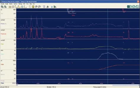 Normal Urodynamic Tracing Of Pressure And Flow Realation Download