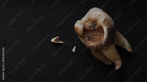 Tooth Decay On Black Background Macro Shot Of A Decayed Teeth Till
