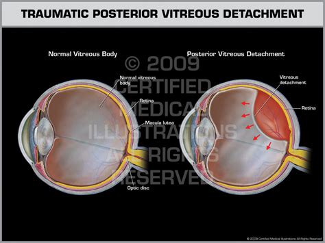 Posterior Vitreous Detachment