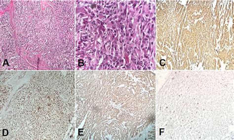 Sertoli Cell Tumor In Patient With Multiple Intratesticular Cysts