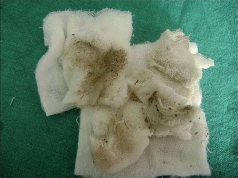 Dermatitis Neglecta Indian Journal Of Dermatology Venereology And