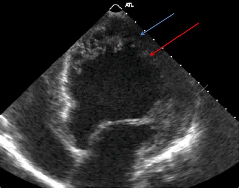 Left Ventricular Noncompaction Intechopen