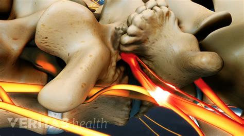 What Spinal Cord And Nerve Compression Feels Like