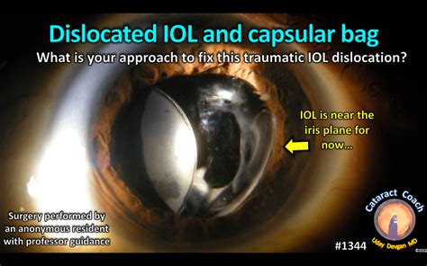 1344 Dislocated Iol And Capsular Bag Cataract Coach™