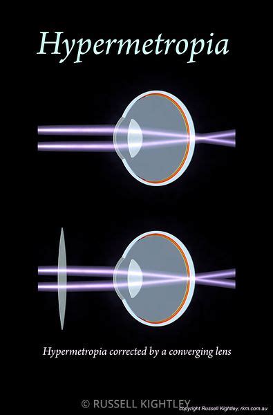 Russell Kightley Scientific Illustrator And Animator Hypermetropia