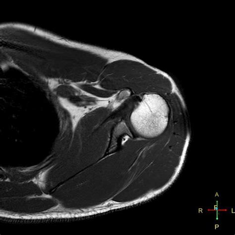 Subcoracoid Impingement Pacs