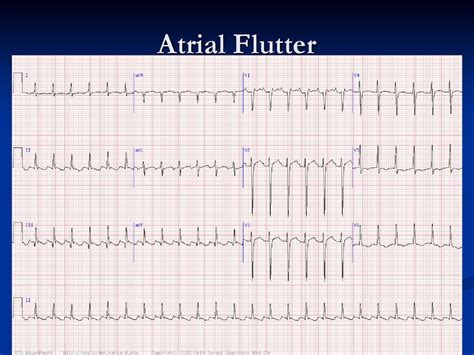 Practical Electrocardiography Rate And Rhythm Ppt Download