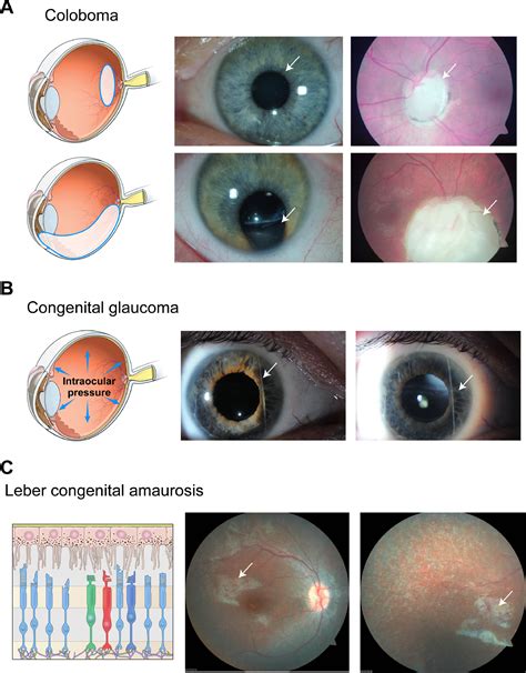 Human Eye Mutations