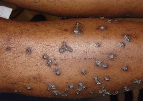 Vermiculate Atrophoderma