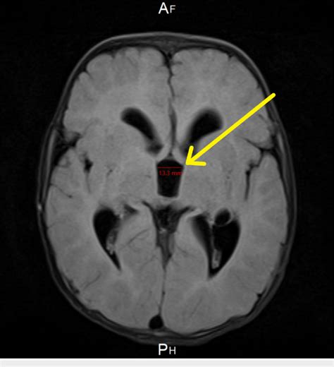Brain Mri Showing Dilation Of The Third Ventricle Download Scientific Diagram