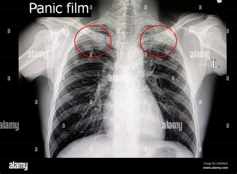 X Ray Chest Tuberculosis