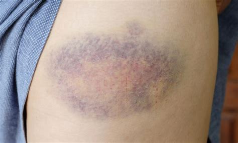 Formas Naturales De Tratar Los Hematomas