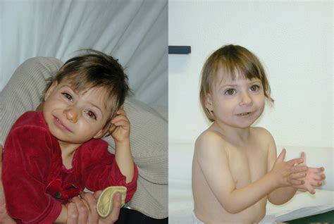 Primordial Dwarfism Mopd Type 1