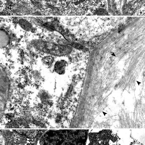 Thymoma Cat No 1 Neoplastic Cells Are Connected By Desmosomes