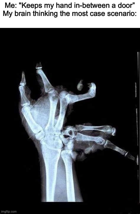Broken Hand Memes How Things Work Some People Go To Extraordinary