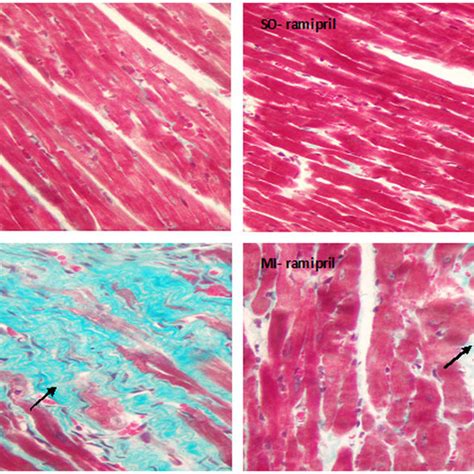 Myocaridal Fibrosis After Myocardial Infarction Detected By Massons