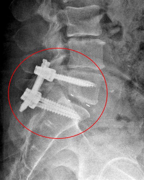 Dr Vikas Varma Minimally Invasive Transforaminal Lumbar Interbody