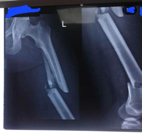 Segmental Femur Shaft Fracture 33 Year Old Male With Rta Developed