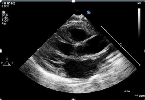 Transthoracic Echo Parsternal Long Axis View Shows Recovered Lv