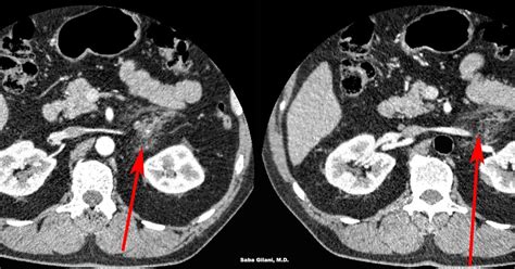 Roentgen Ray Reader Mesenteric Hematoma Revisited