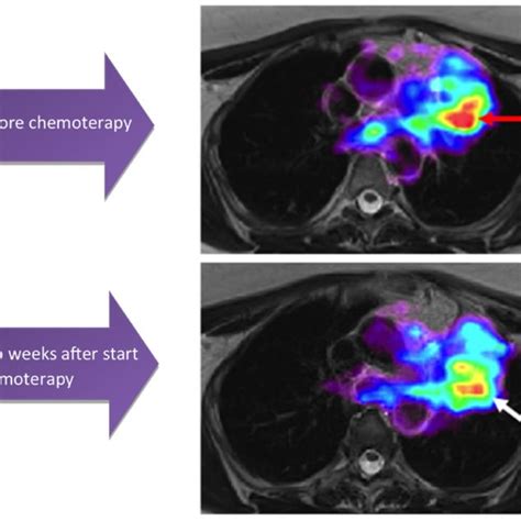 Representative Ptld Patient For Each Morphological Subtype With Suv