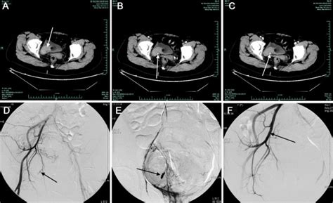 Pelvic Computed Tomography And Angiography Showed The Source Of The