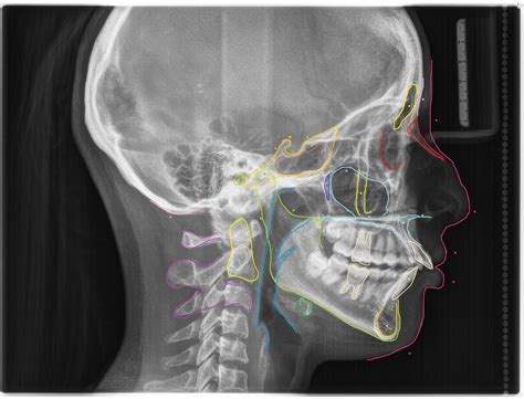 Anatomía De La Radiografía Lateral Del Cráneo Ap Lateral De Craneo