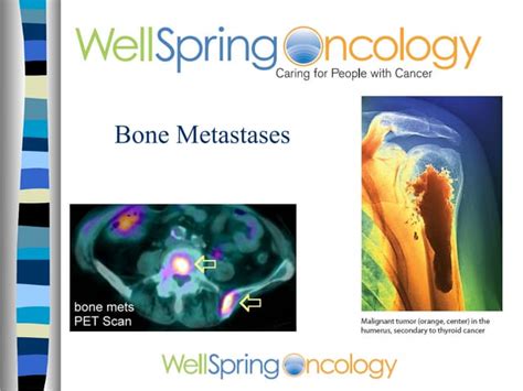 Bone Mets Video Ppt