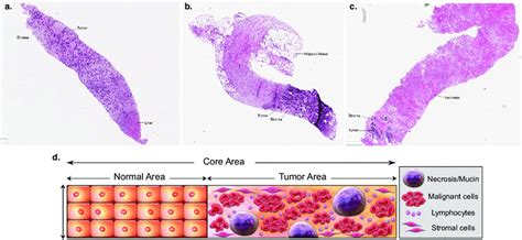 Biopsy Core A A Photomicrograph Of A Representative Core Biopsy