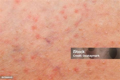 Folikulitis Pada Kulit Wanita Foto Stok Unduh Gambar Sekarang