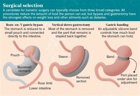 Partial Gastrectomy Procedure