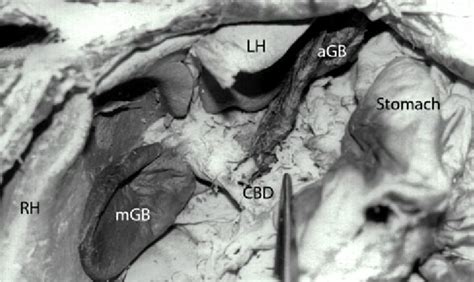 Duplicated Gallbladder The Main Gallbladder Is Positioned At The Download Scientific Diagram